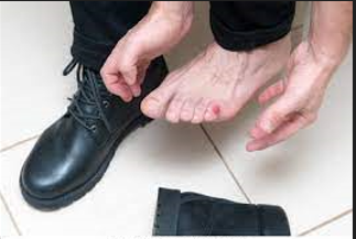 Shoe bite Reasons and Methods for Treatment and Prevention